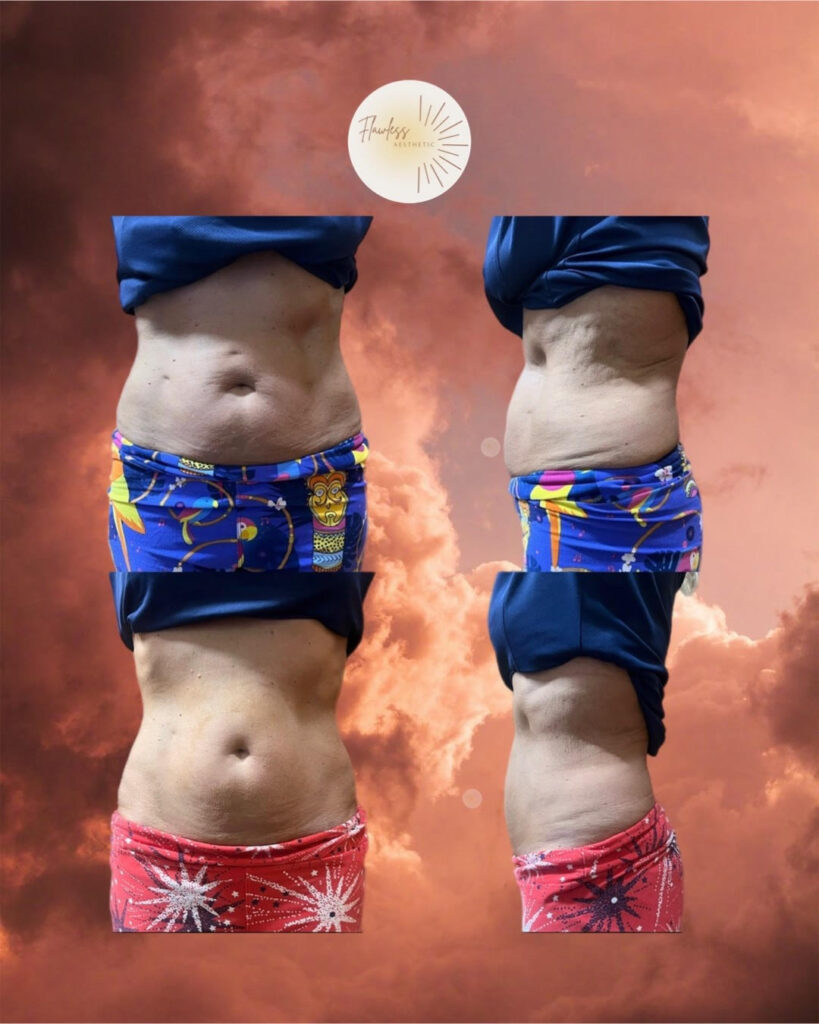 Muscle Sculpt - flawlessaesthetic